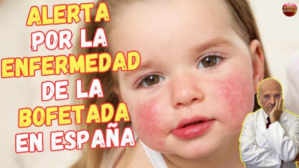 Virus de la bofetada en adultos: ¿la nueva plaga que nadie vio venir ...