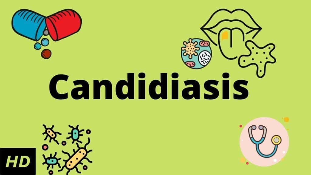 ¡Adiós candidiasis! Descubre el secreto para decirle adiós de una vez ...